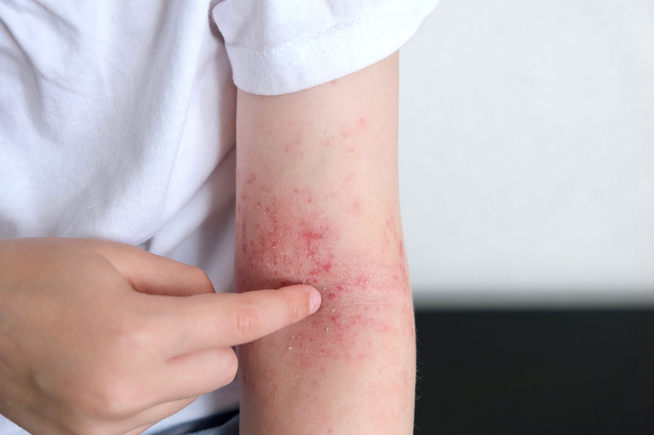 Rash on arm treatment store
